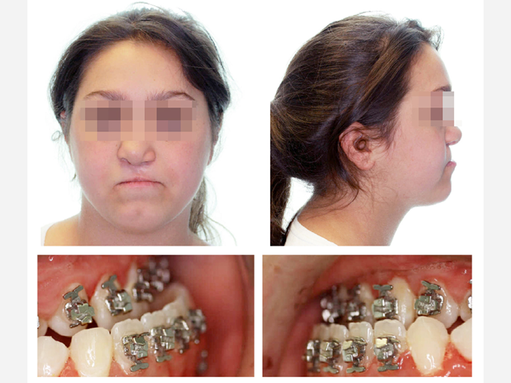 Distractor intraoral KLS Martin en el tratamiento de la Hipoplasia ...